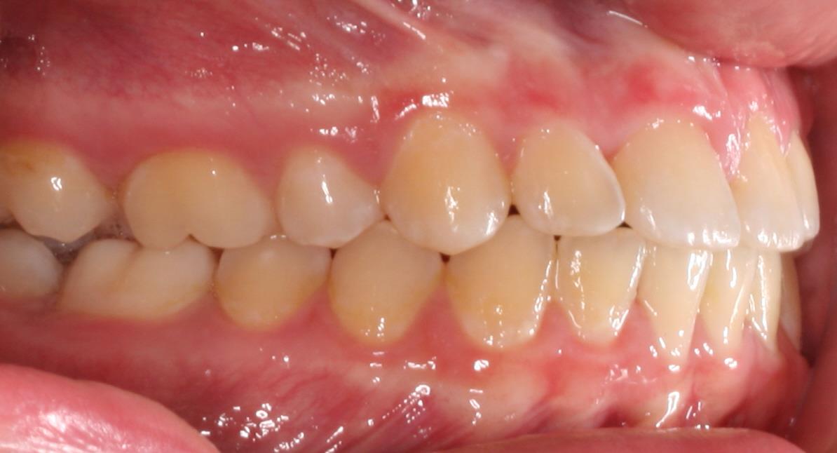 Before and After – Woloshyn Orthodontics